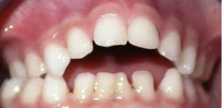 Malocclusion of teeth or Misaligned teeth – Uttam Dental Clinic